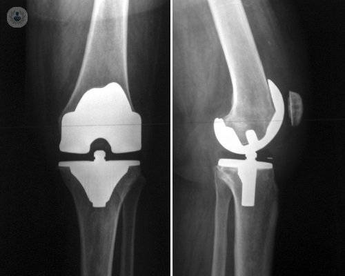 Artoplastia. Los beneficios de la prótesis de rodilla | Top Doctors