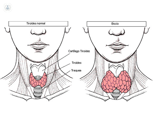 Bocio multinodular: qué es, síntomas y tratamiento | Top Doctors