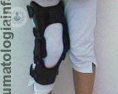 Rodillas valgas o Piernas en X | Top Doctors | Top Doctors