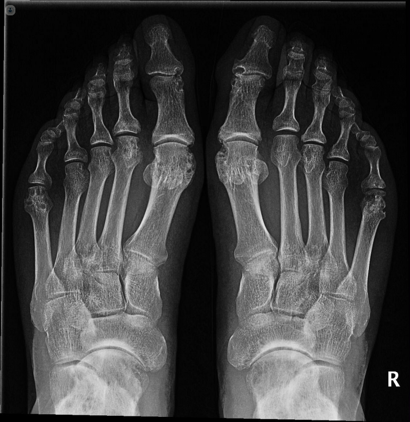 Artritis Reumatoide S ntomas Causas Diagn stico Y Tratamiento Top Artritis Reumatoide S ntomas Causas Diagn stico Y Tratamiento Top
